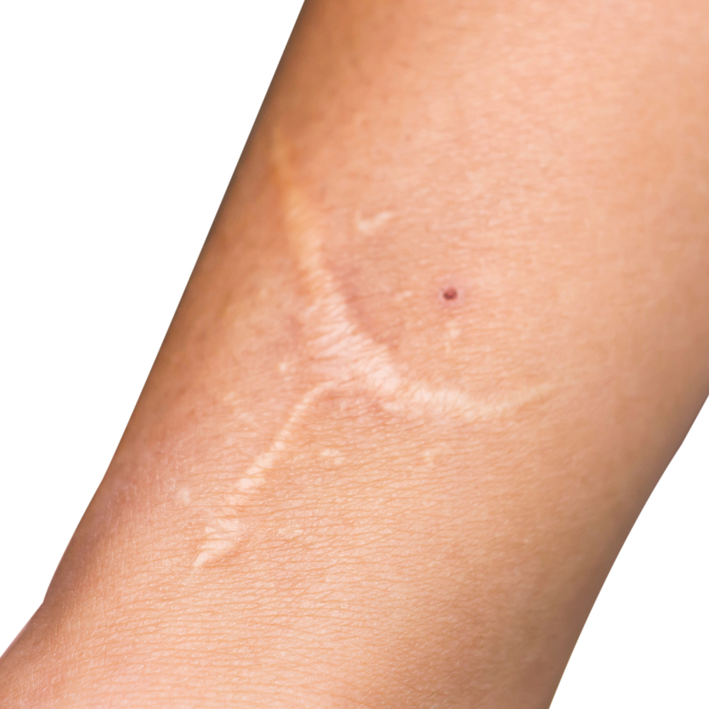 Liệu trình điều trị sẹo lồi nhẹ - Ed Beauty (Clinic & Spa)