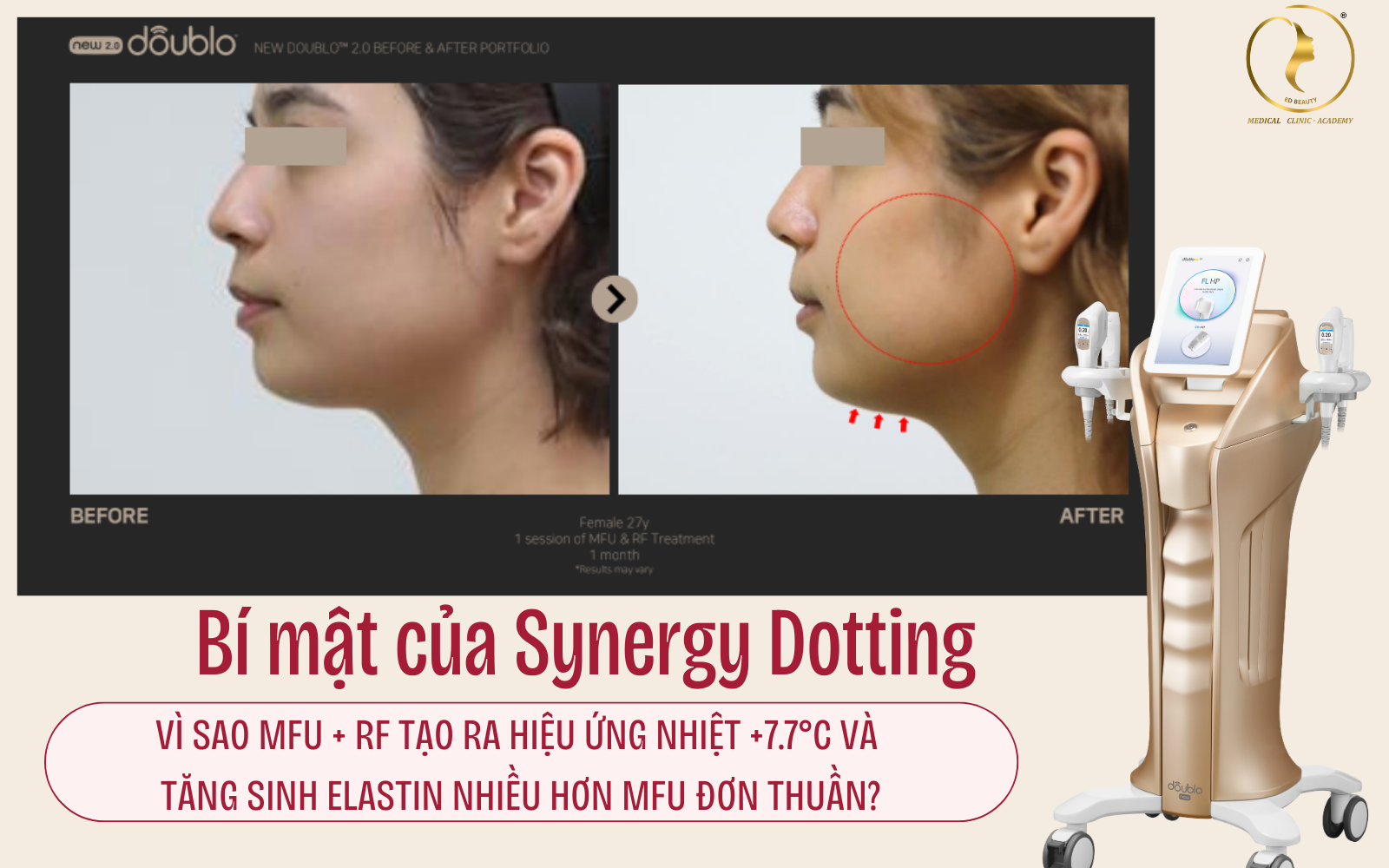 Bí mật của Synergy Dotting: Vì sao MFU + RF tạo ra hiệu ứng nhiệt +7.7 ...